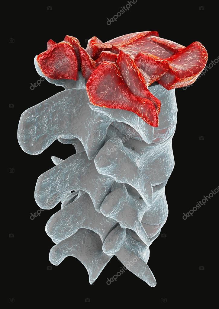 Traumatic vertebral fracture, burst fracture Stock Photo by ©vampy1 ...