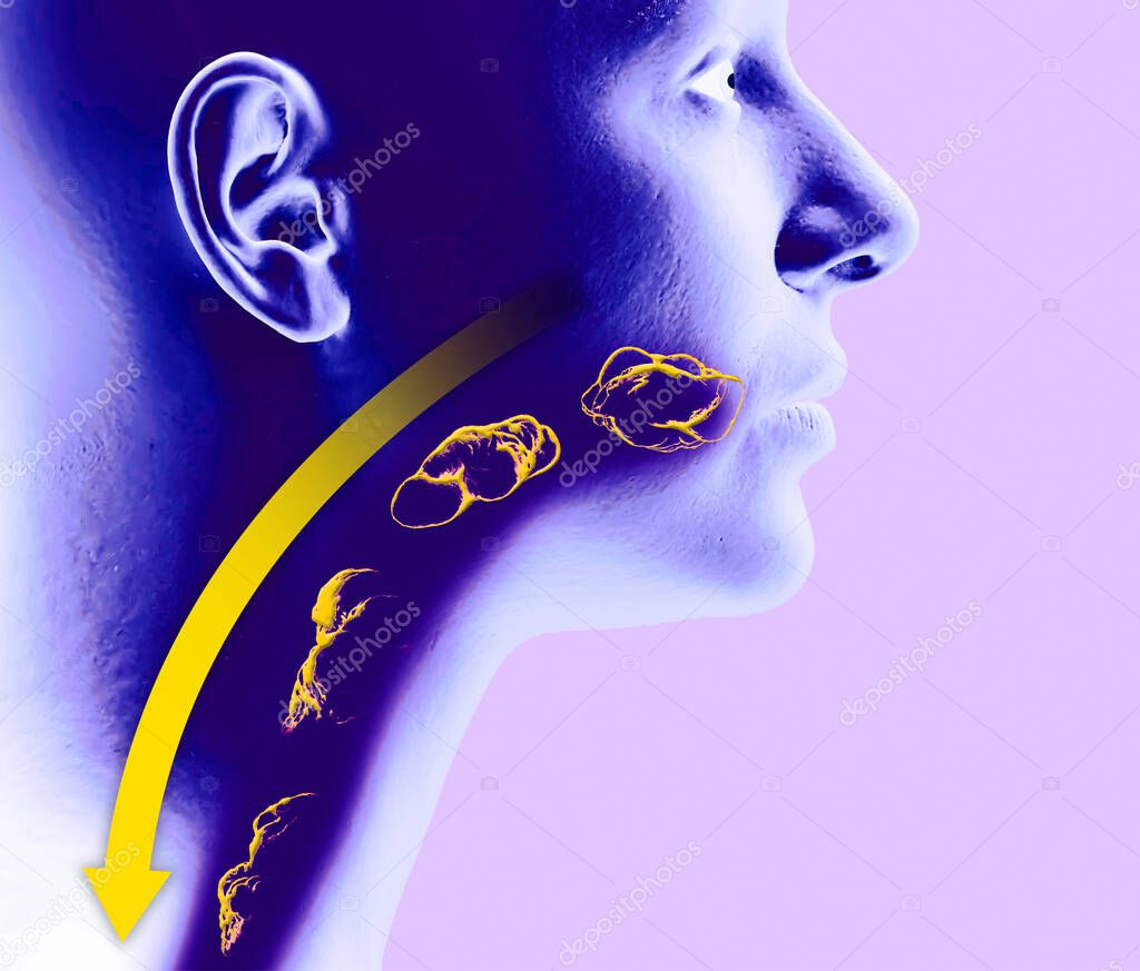 Trastornos de la deglución, disfagia. Disfagia faríngea y esofágica ...