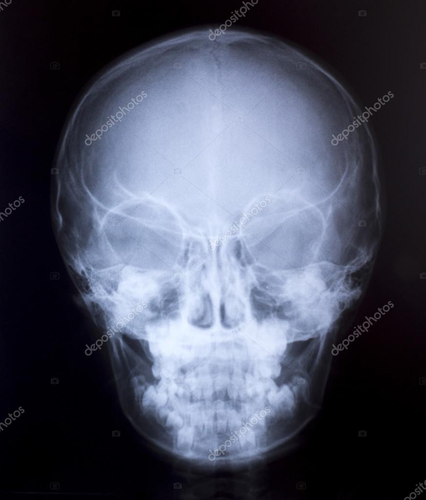 X-Ray Image Of Human Chest for a medical diagnosis — Stock Photo ...