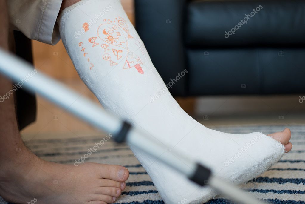 Man met een been gips ⬇ Stockfoto, rechtenvrije foto door © racorn ...