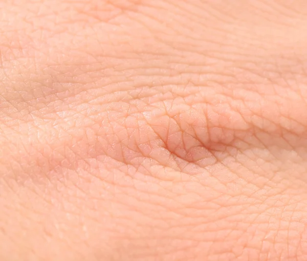 Hypertrofische litteken Stock Photos, Royalty Free Hypertrofische ...