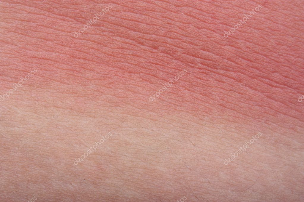 Burned Skin Texture