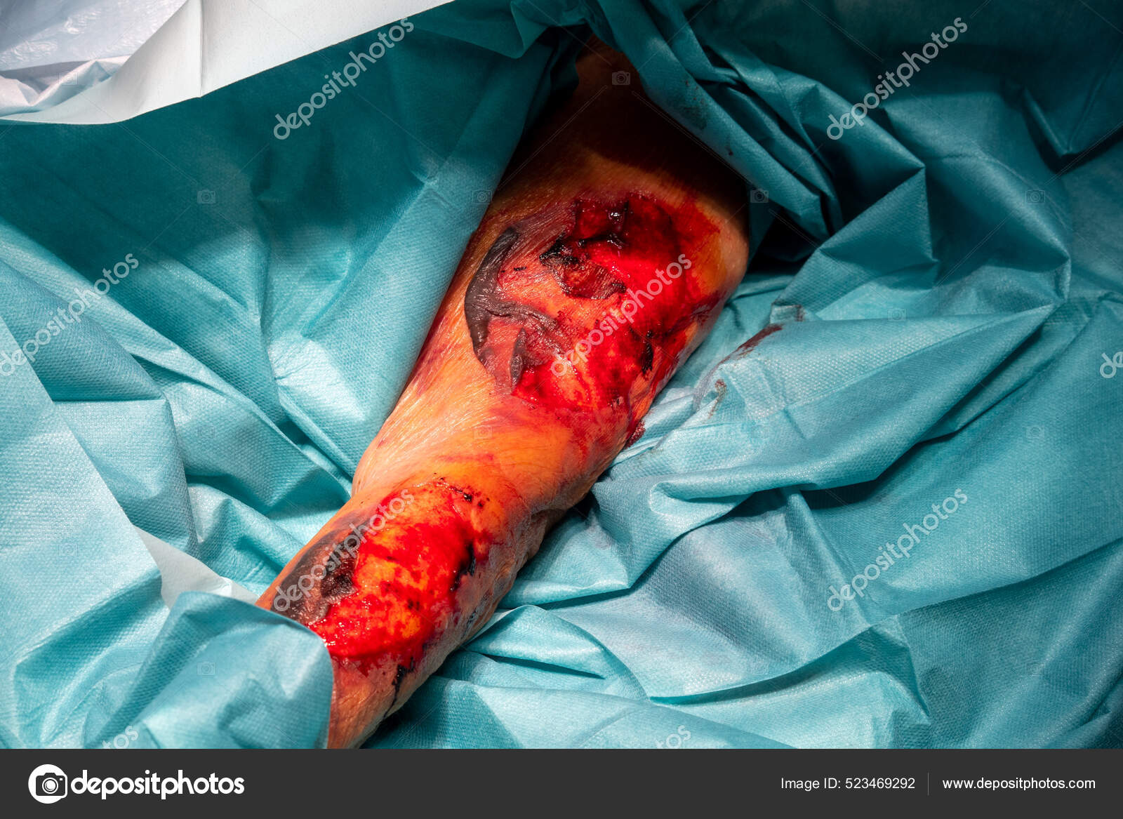 Arm Patient Has Severe Injuries Skin — Stock Photo © karegg #523469292