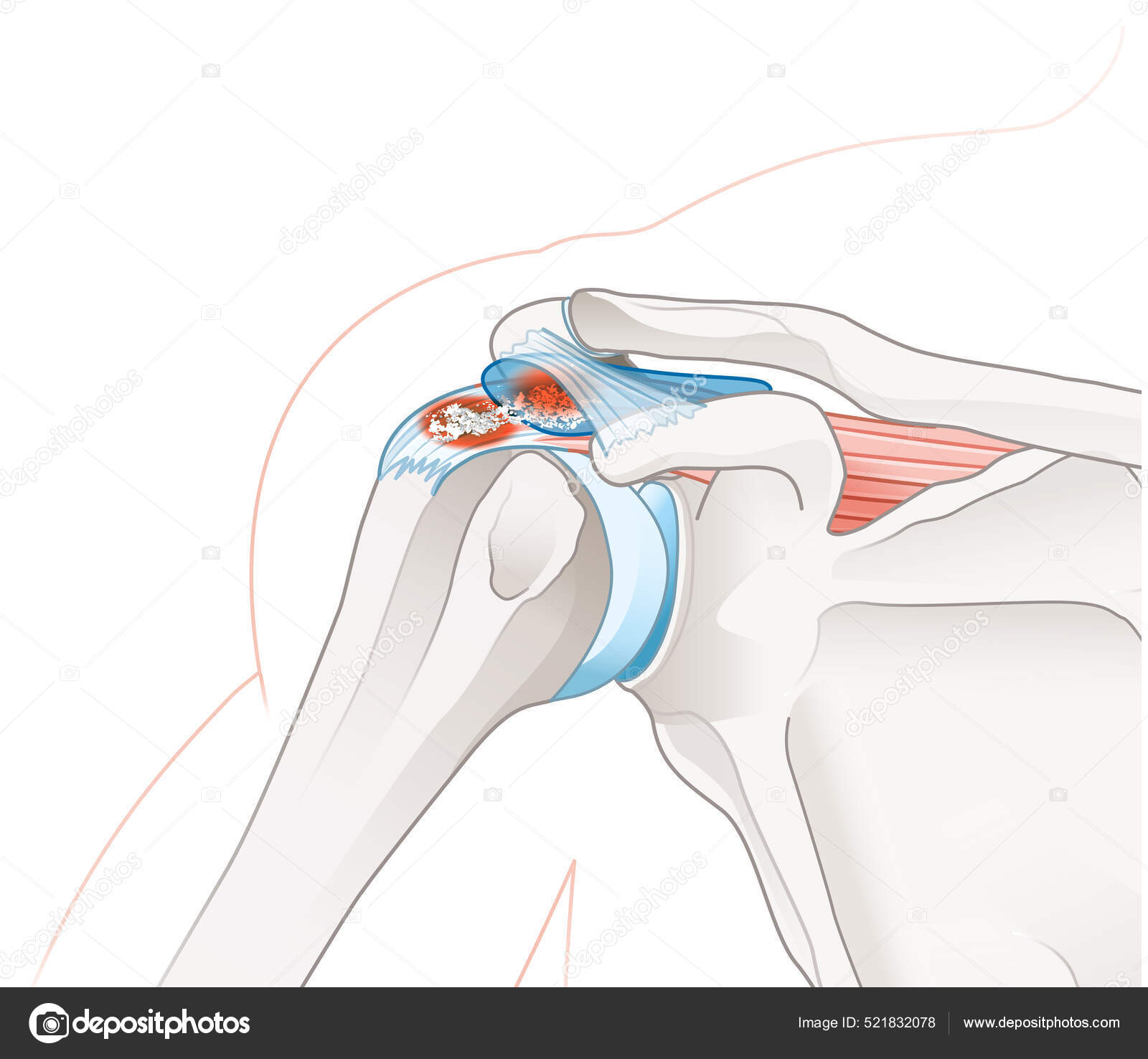 Ilustración Que Muestra Tendinitis Calcifica Bursitis Calcifica ...