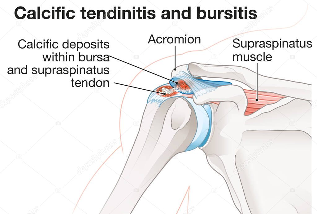 Ilustración que muestra tendinitis calcifica y bursitis calcifica 2022
