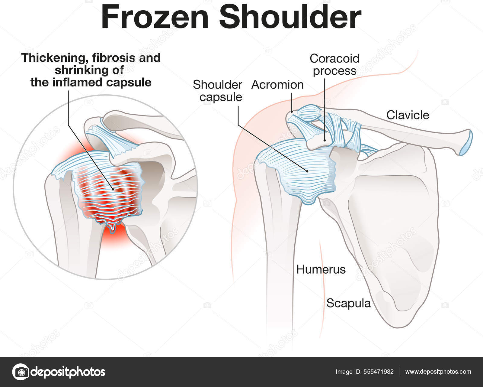 Afbeelding Toont Bevroren Schouderlijm Capsulitis Illustratie ...
