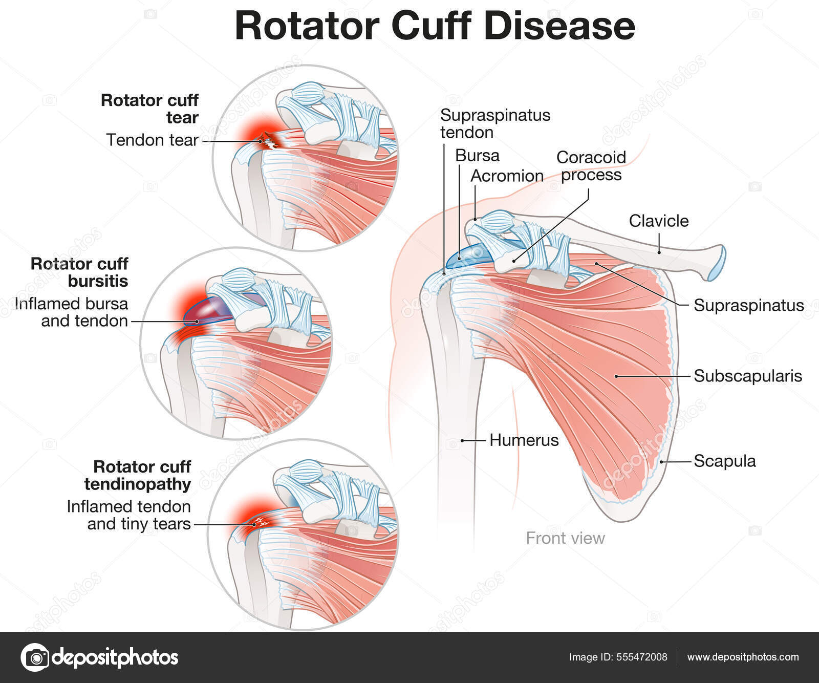 Illustration Showing Shoulder Rotator Cuff Disease Illustration Stock ...