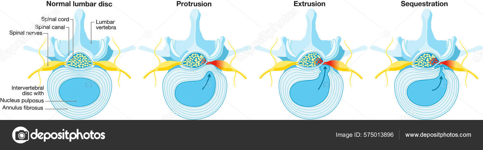 Illustration Showing Herniated Disc Schema Normal Disc Bulge Protrusion ...