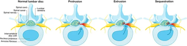 Ilustración que muestra un esquema de hernia discal. Disco normal ...