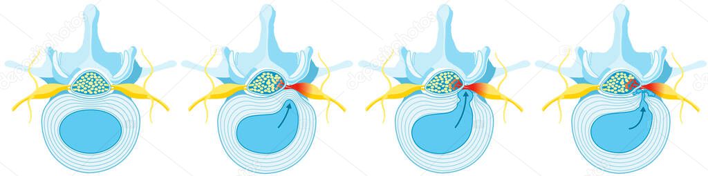 Disc protrusion Stock Photos, Royalty Free Disc protrusion Images ...