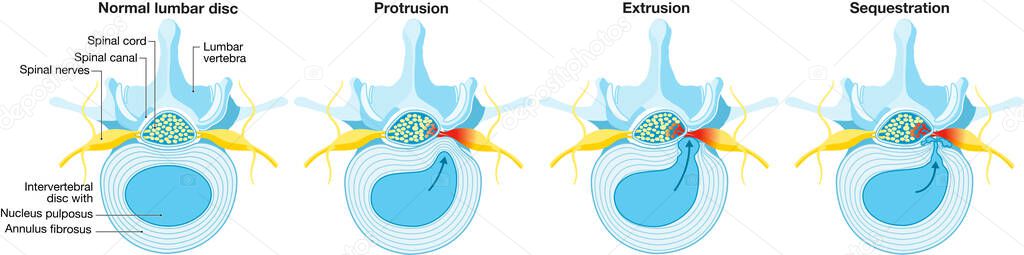 Ilustración que muestra un esquema de hernia discal. Disco normal ...