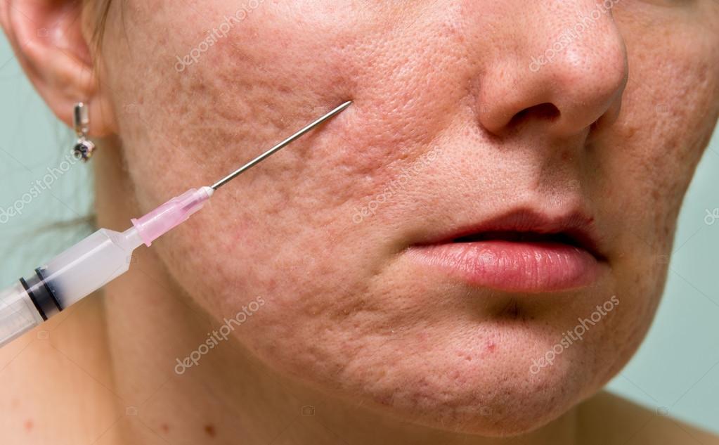 Papules Acne On Chin