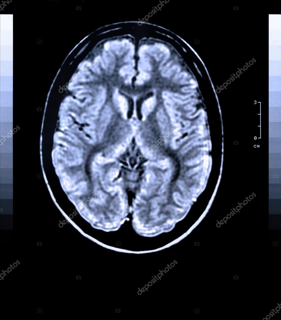 Healthy Human Brain Mri