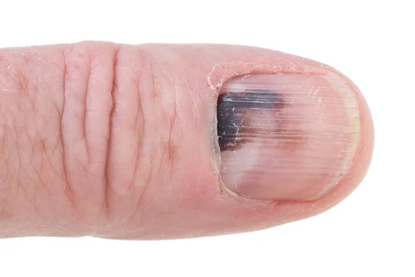 Finger with Bruised Nail (Subungual Hematoma) Stock Photo by ...