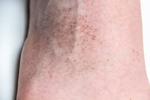 A red rash on the foot of a male against background. CloseUp a part of ...