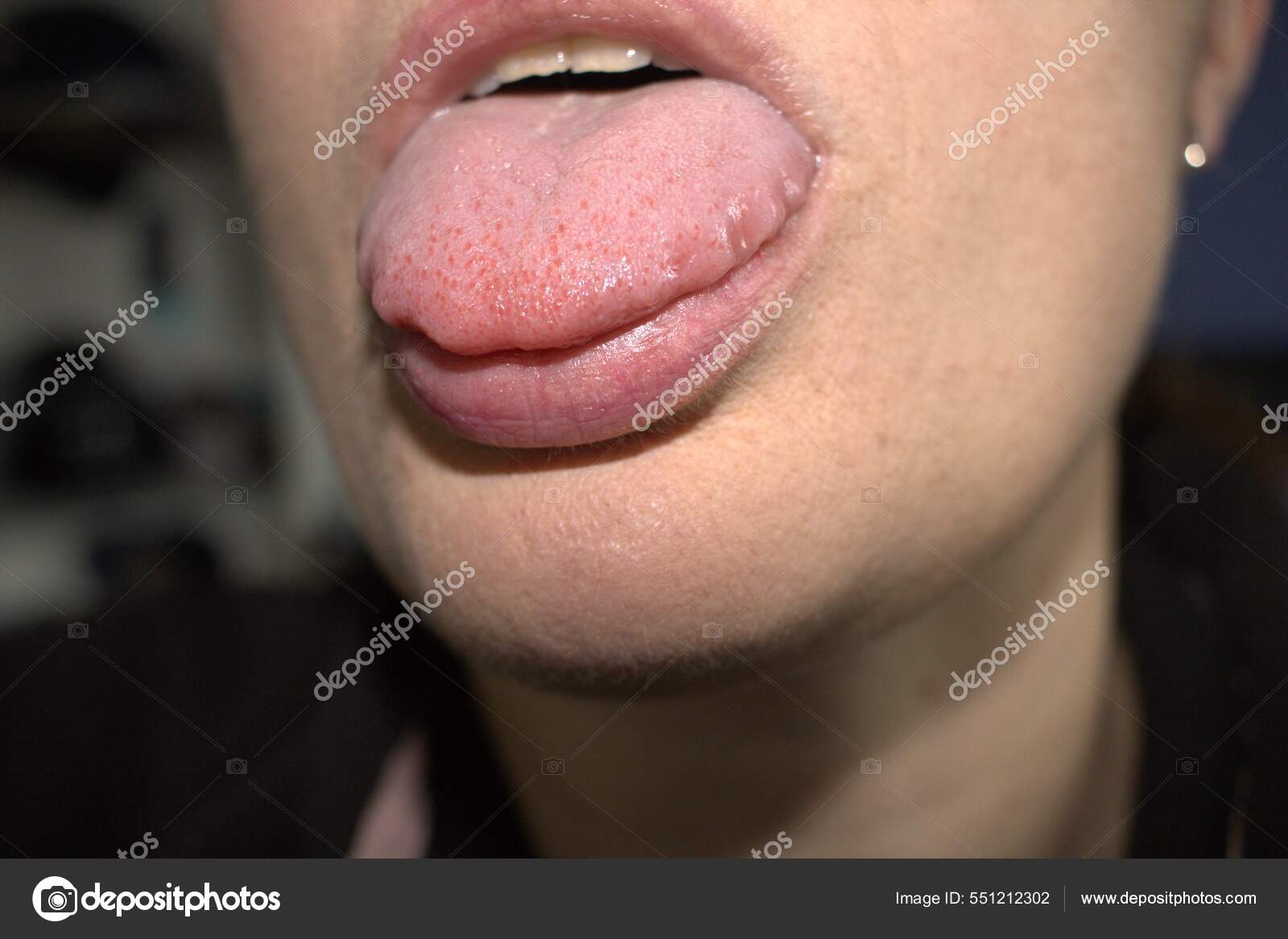 Swollen Enlarged White Tongue Wavy Ripple Scalloped Edges Medical Name ... Swollen Enlarged White Tongue Wavy Ripple Scalloped Edges Medical Name ...