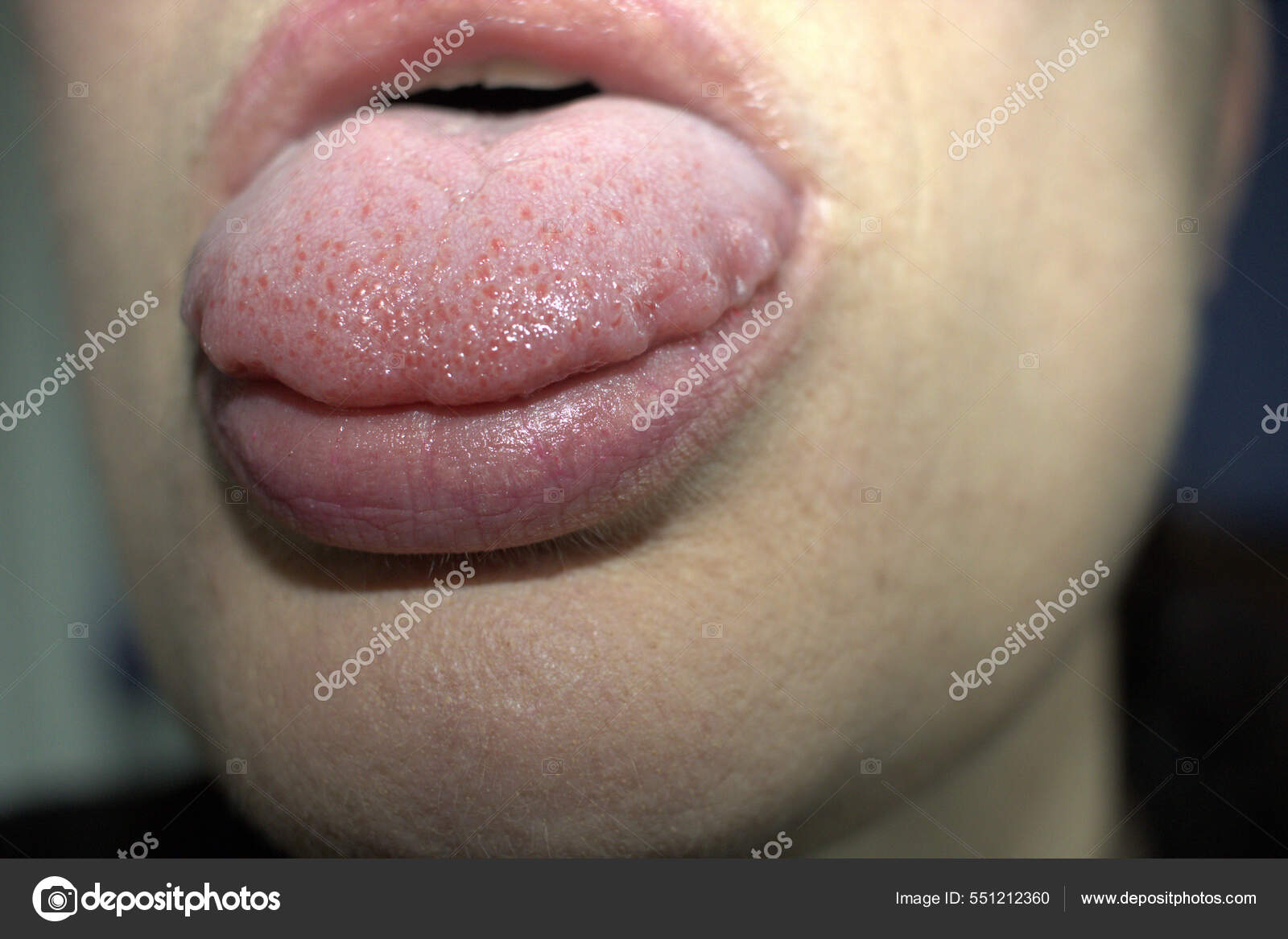 Swollen Enlarged White Tongue Wavy Ripple Scalloped Edges Medical Name ... Swollen Enlarged White Tongue Wavy Ripple Scalloped Edges Medical Name ...