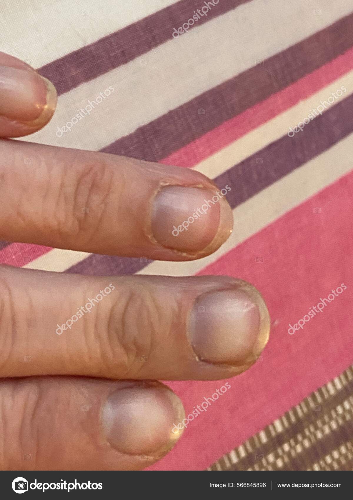 Unusual Shrunken Missing Lunula Half Moon Nails Which Symptom Anaemia ...