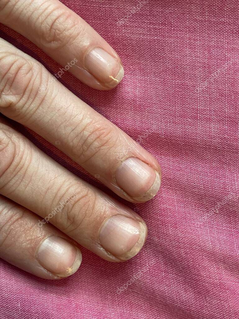 unusual shrunken missing lunula half moon on nails which is symptom of ...