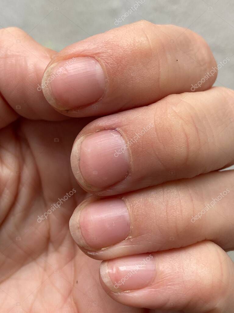 unusual shrunken missing lunula half moon on nails which is symptom of ...