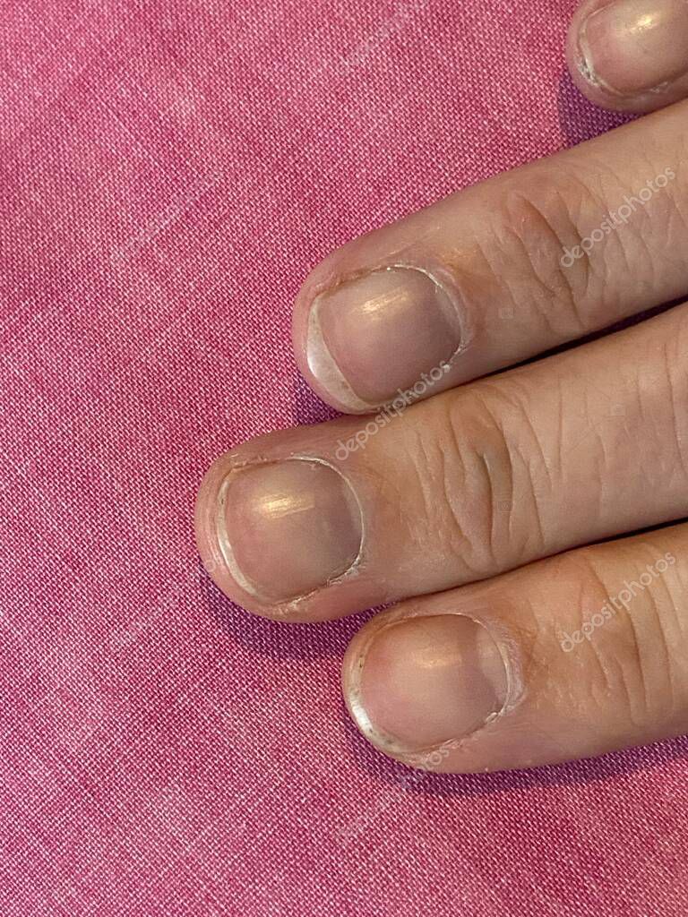 unusual shrunken missing lunula half moon on nails which is symptom of ...