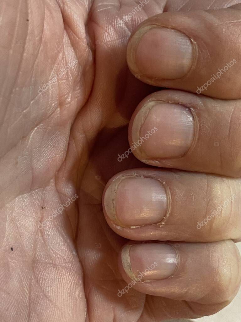 inusual encogido falta lunula media luna en las uñas que es síntoma de ...