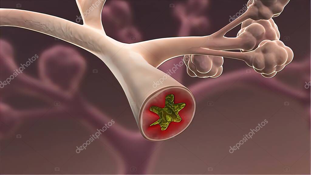 Los alvéolos son los sacos de aire en el extremo del árbol respiratorio de los pulmones y son ...