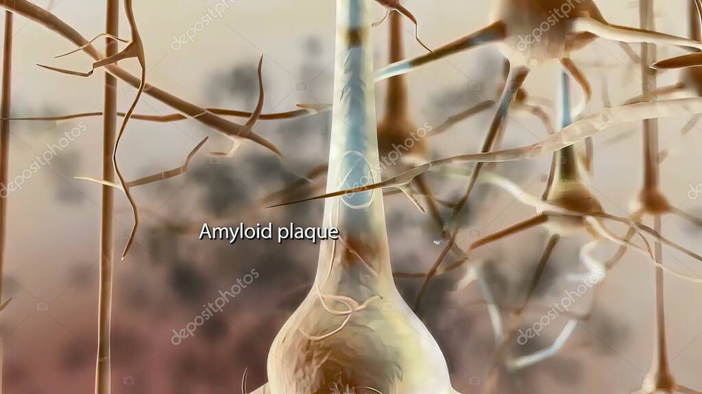 3d medical illustration Placas amiloides. La proteína beta-amiloide ...