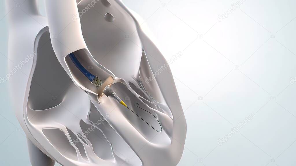 Expansión del implante transcatéter de válvula aórtica.3D Medical 3D ...