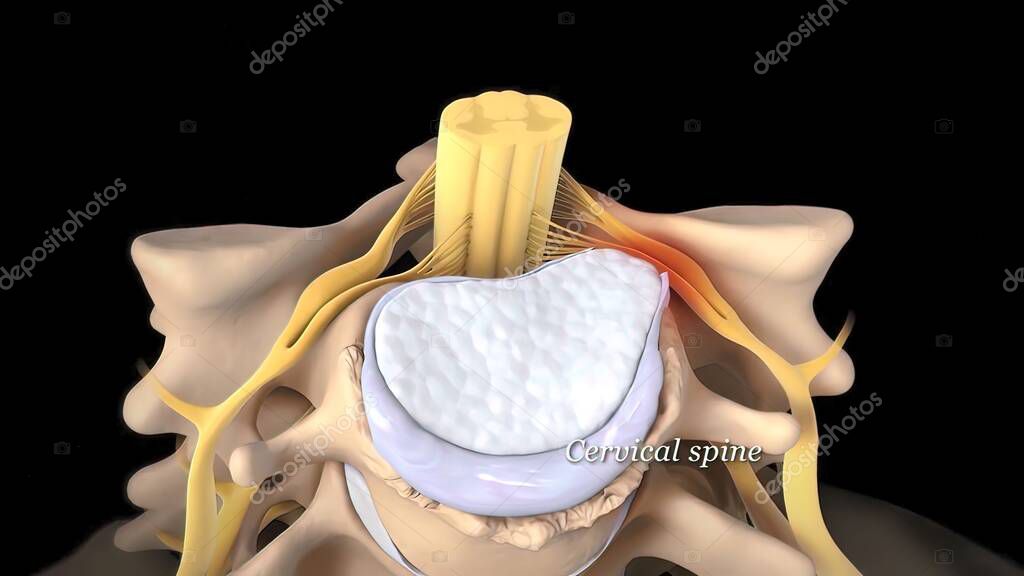 La hernia discal espinal es una lesión en la amortiguación y el tejido ...