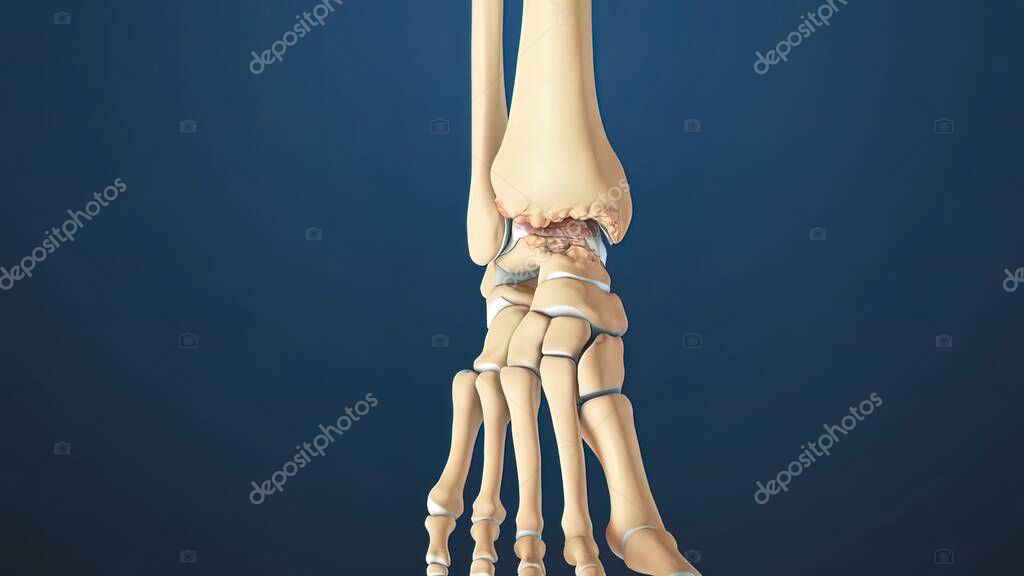 3D Renderizado de la articulación del tobillo Anatomía y osteoartritis ...