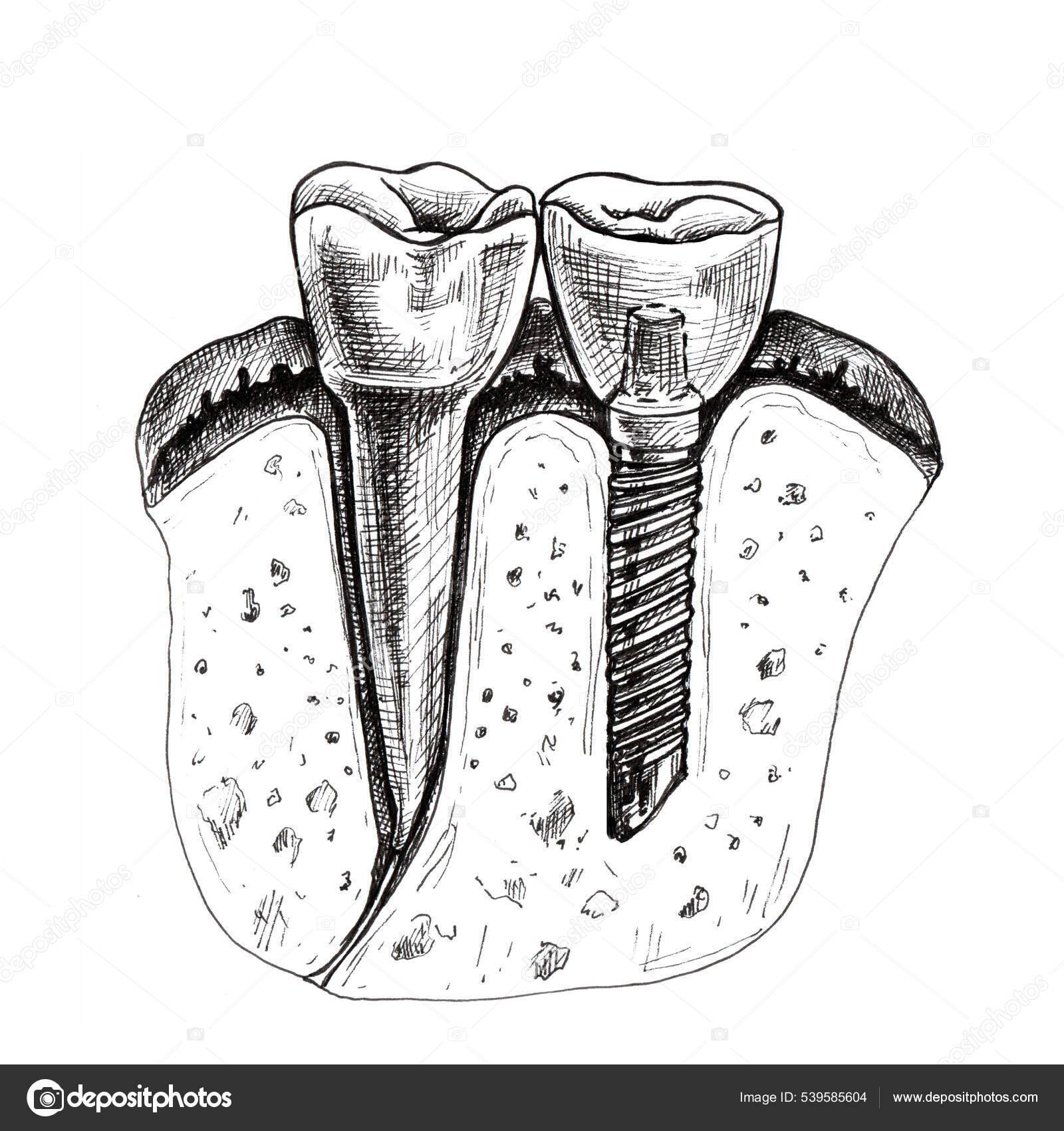 Healthy Tooth Implanted Hand Drawing Graphics Restoration Dentistry ...