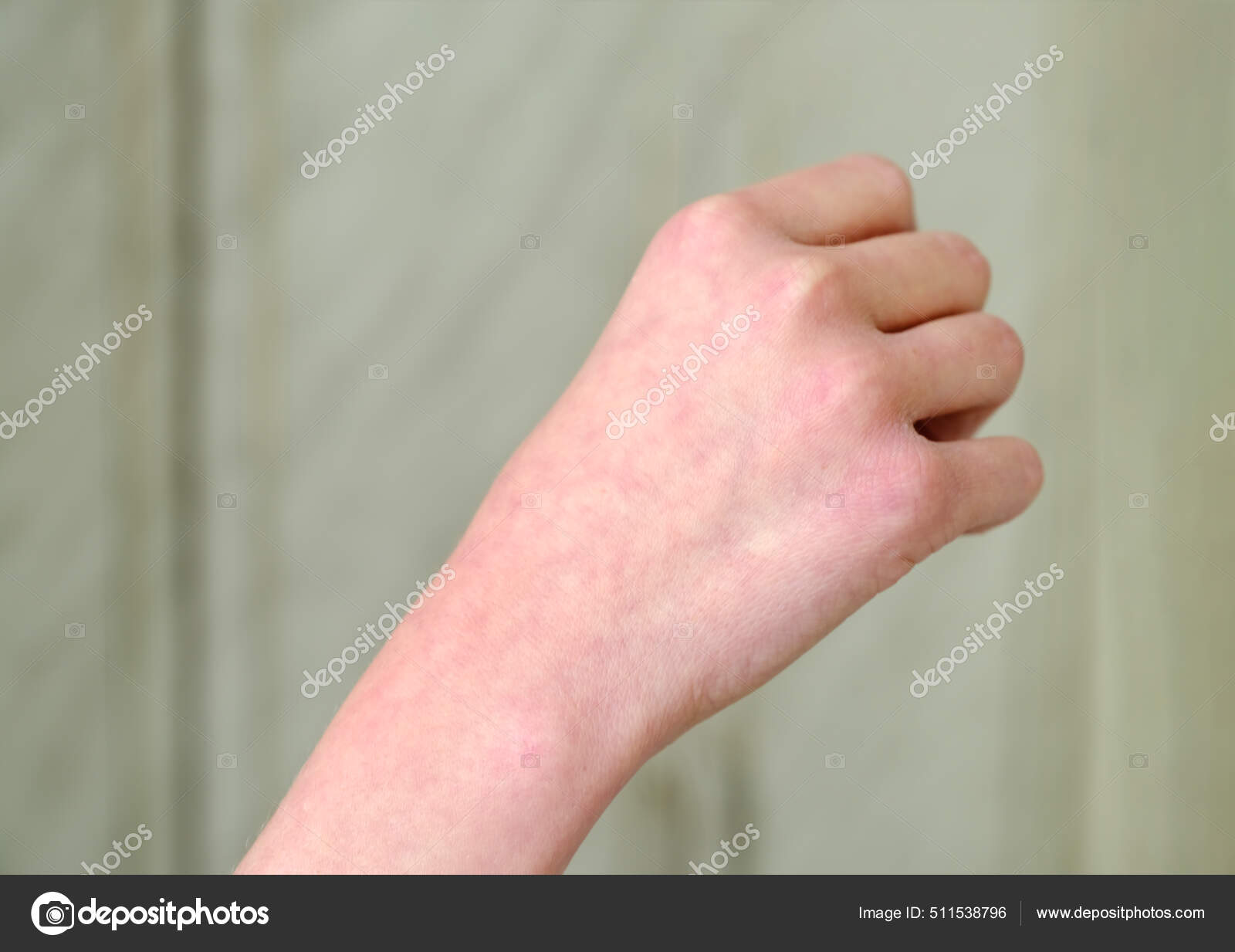 Síndrome Piel Jaspeada Cutis Marmorata Telangiectatica Congenita Una ...