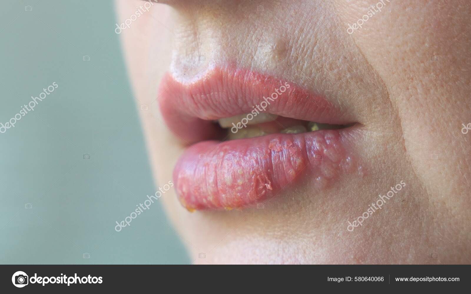 Herpes Disease Women's Lips Close — Stock Photo © vlamin #580640066