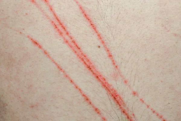 Broke skin Stock Photos, Royalty Free Broke skin Images | Depositphotos