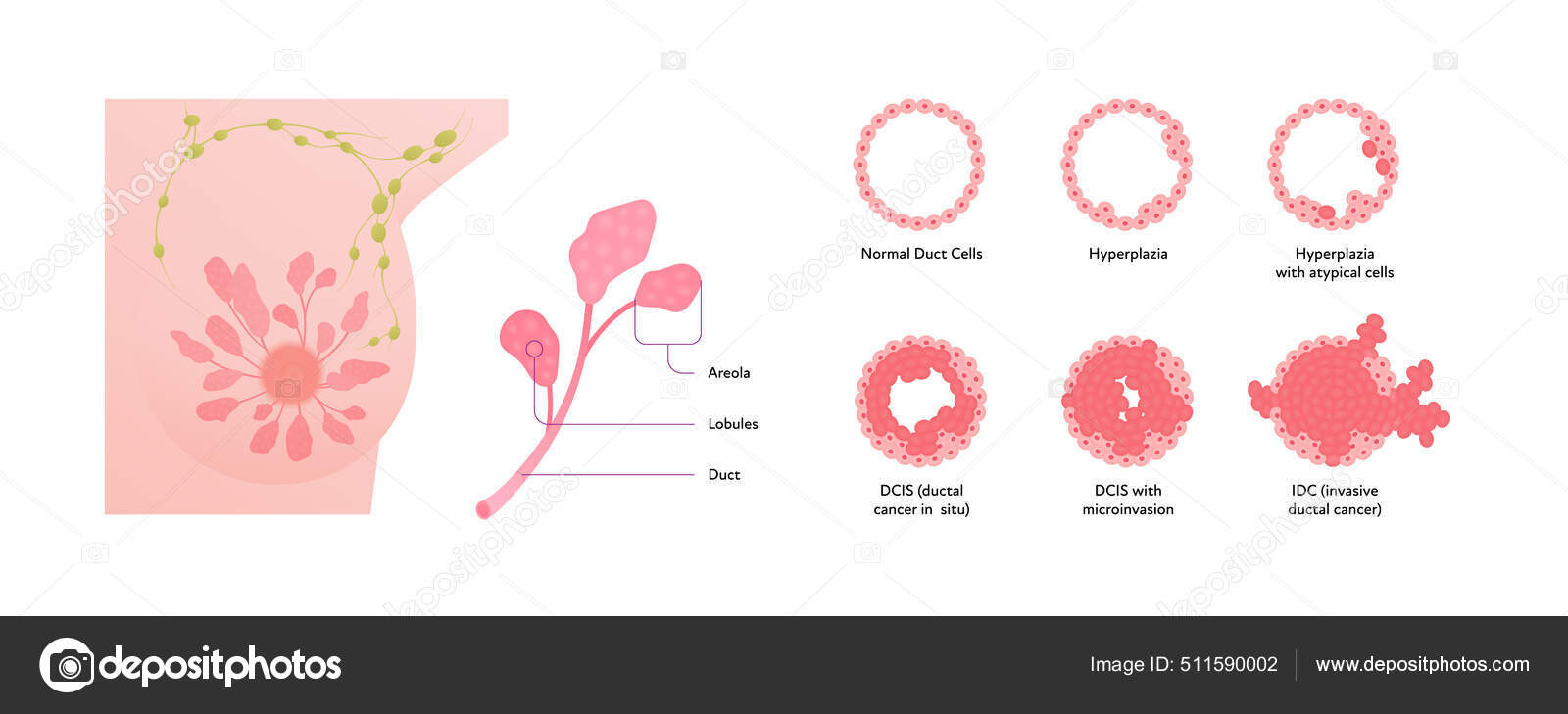 Menselijke Borstkanker Anatomie Diagram Vector Platte Medische ...