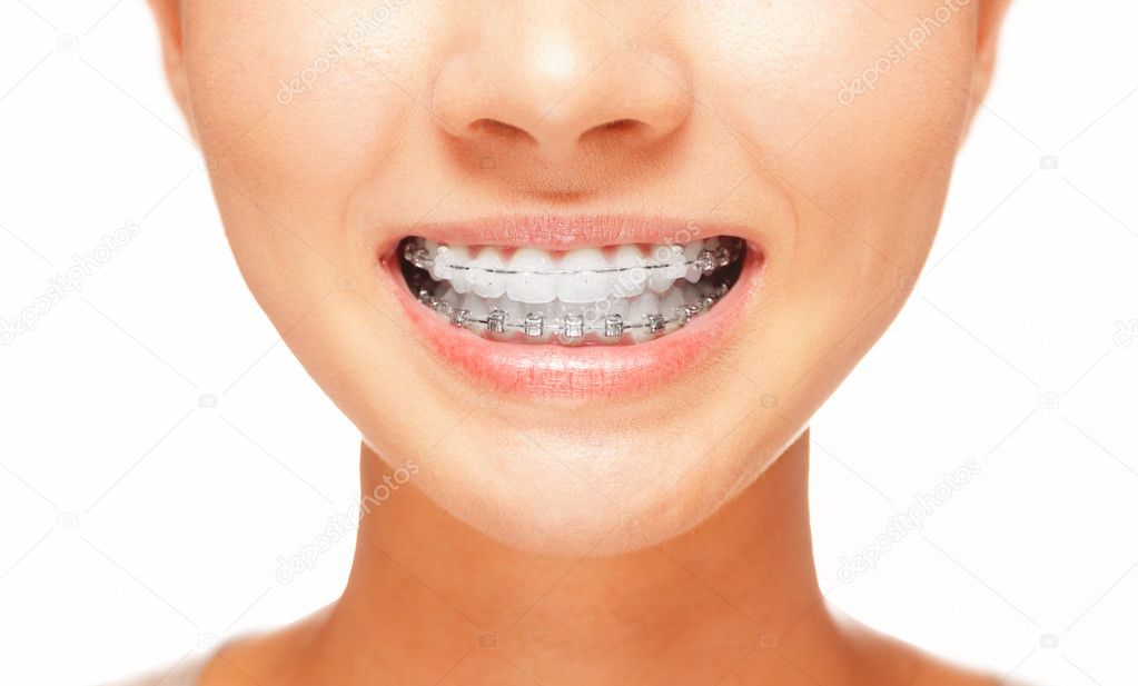 Smile: teeth with braces — Stock Photo © Remains #40674423