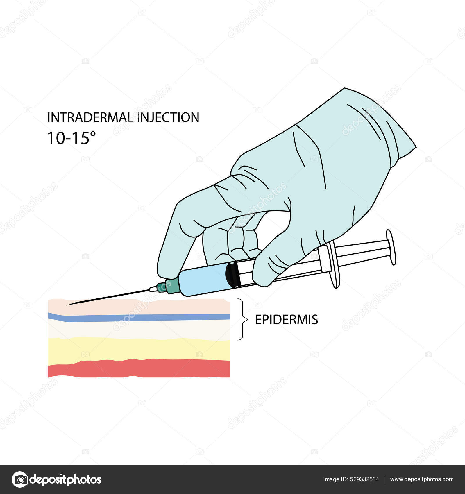 Inyección Intradérmica Métodos Eficaces Administración Medicamentos ...