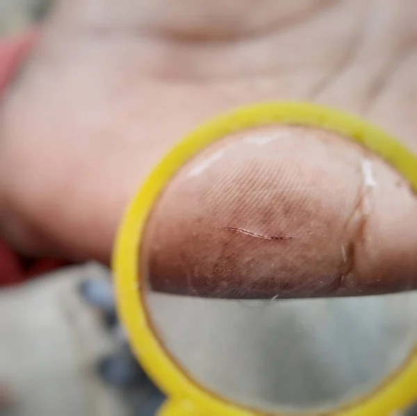 Puncture Wound Hand