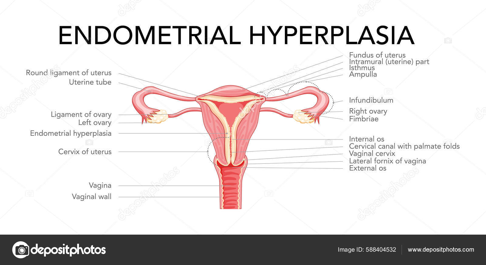 Endometrial Hyperplasia Female Reproductive System Uterus Inscriptions