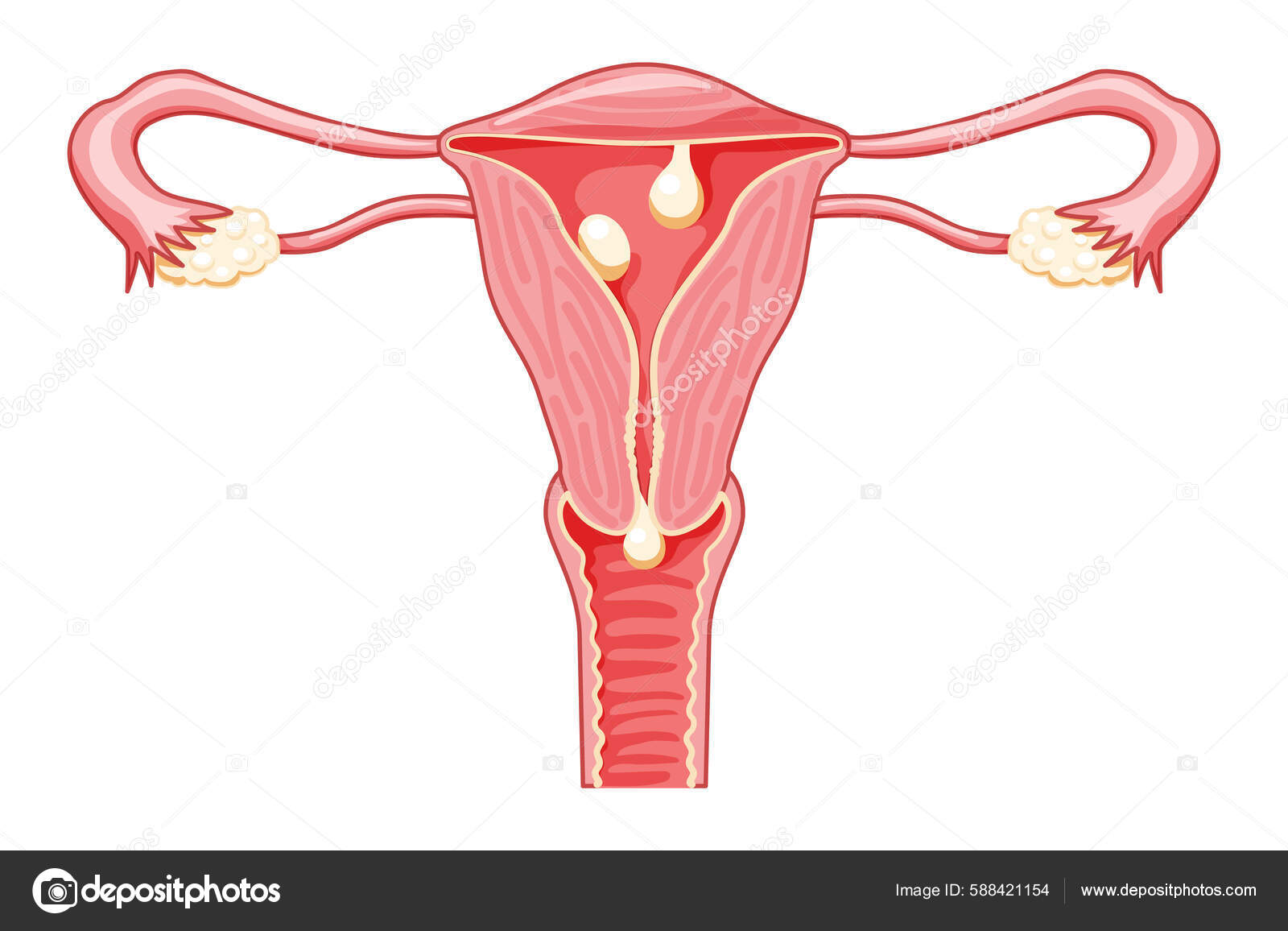 Polyps Uterus Cervical Pedunculated Sessile Female Reproductive System