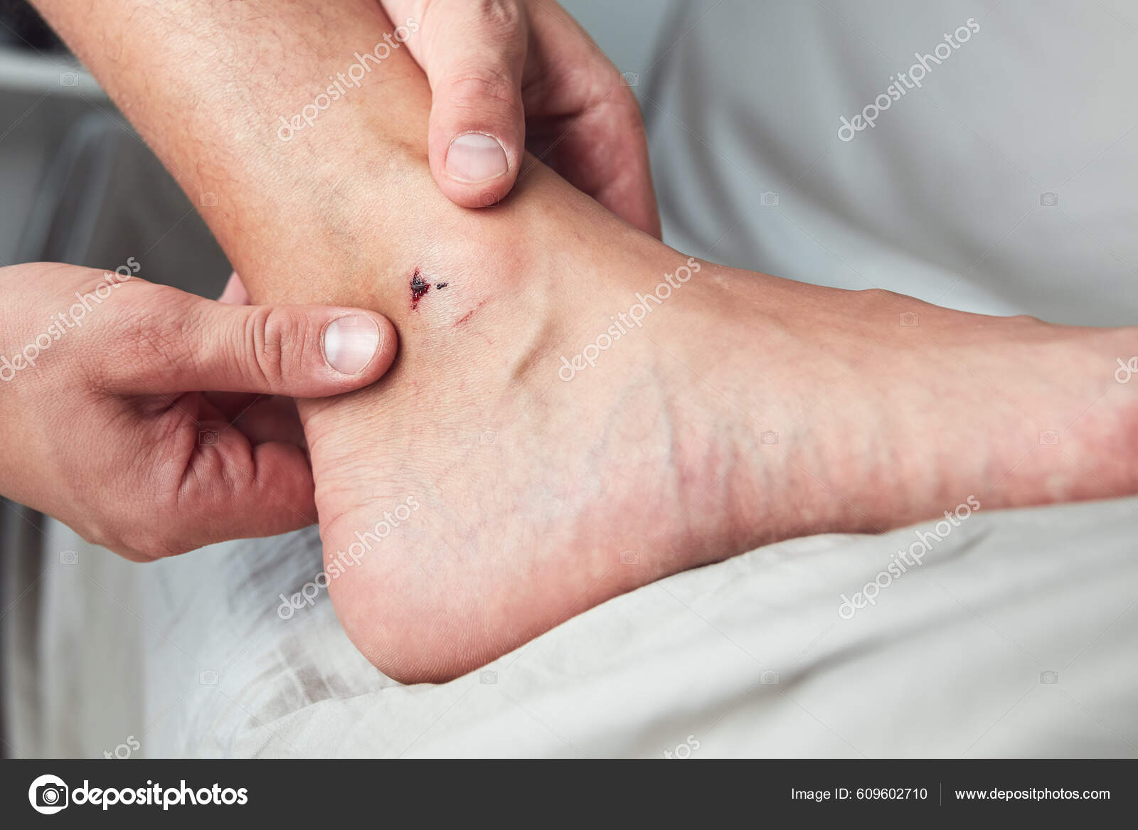 Man's Ankle Cut Skin Scabby Wound Stock Photo by ©milangucci 609602710