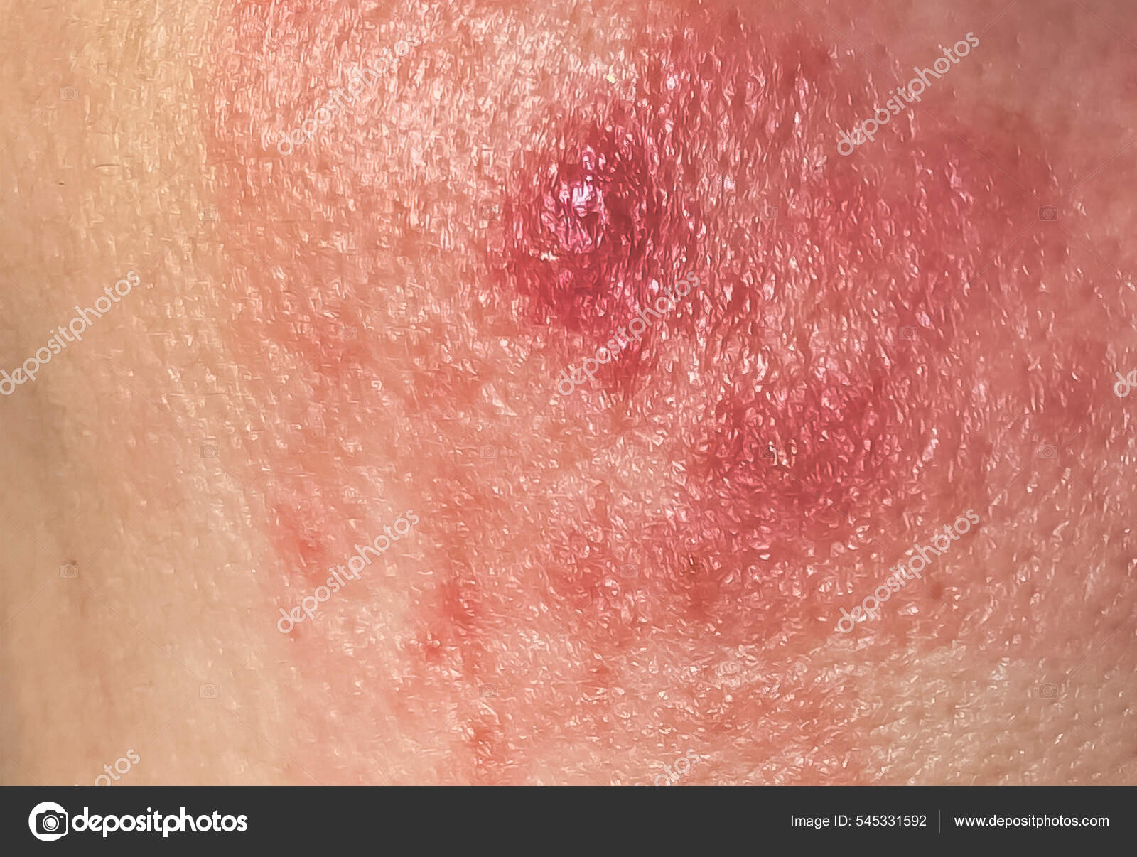Close-up, selective focus, dermatological infection of the skin, in ...