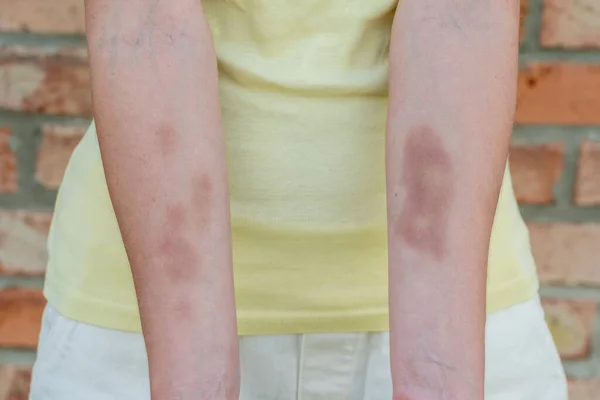 Child bruises Stock Photos, Royalty Free Child bruises Images ...
