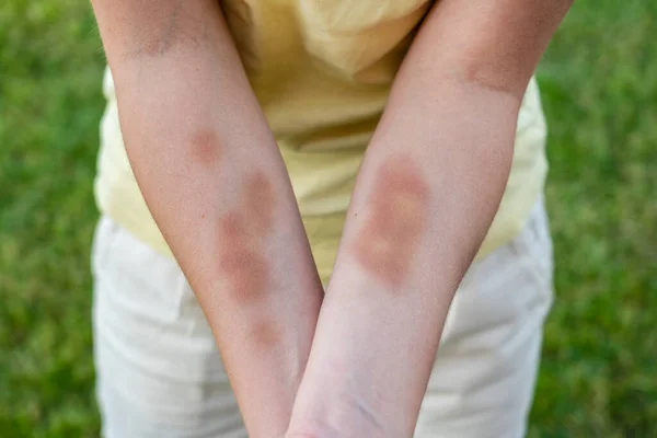 Child bruises Stock Photos, Royalty Free Child bruises Images ...