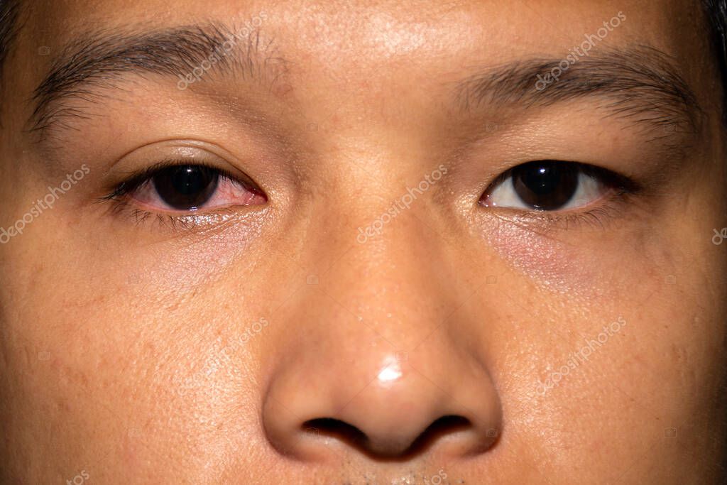 Un hombre tiene ojos rojos causados por conjuntivitis o enfermedad de inflexi n ocular. 2024