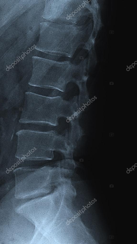 Spine radiograph Stock Photo by ©zacariasdamata 36766617