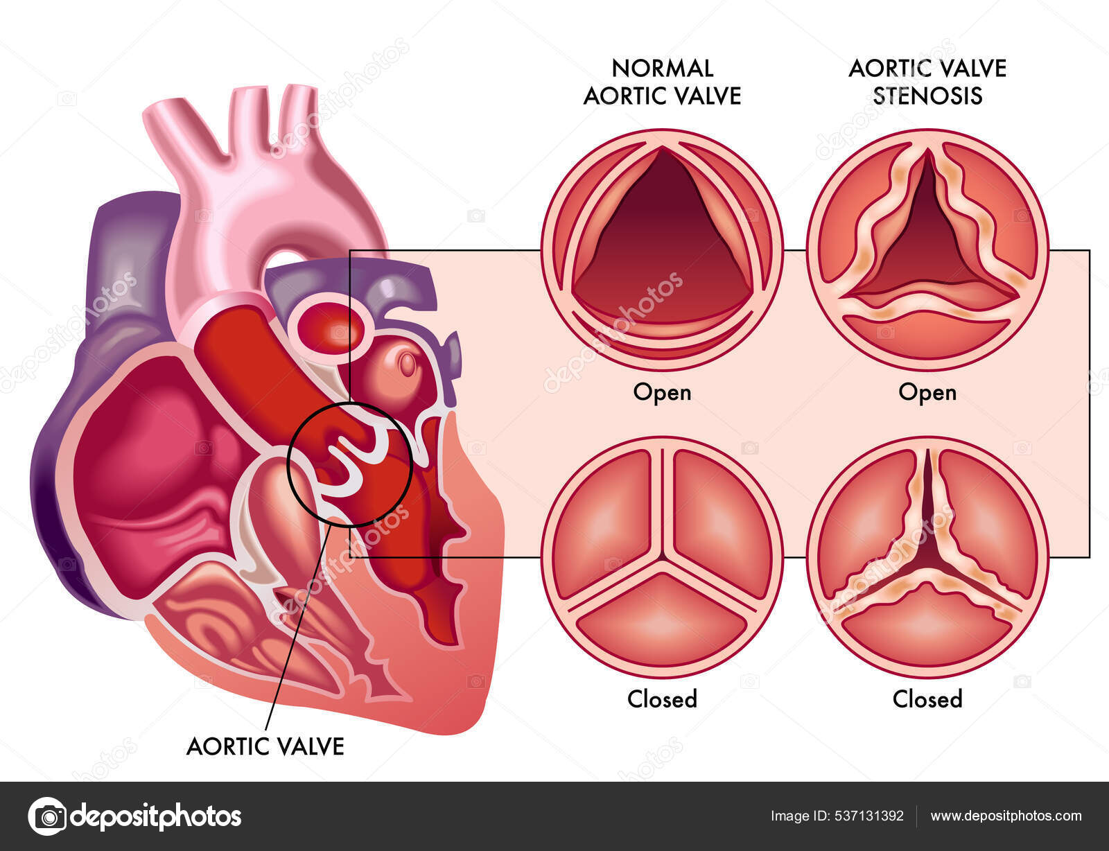 Illustration Vectorielle Sténose Valvulaire Aortique image vectorielle ...