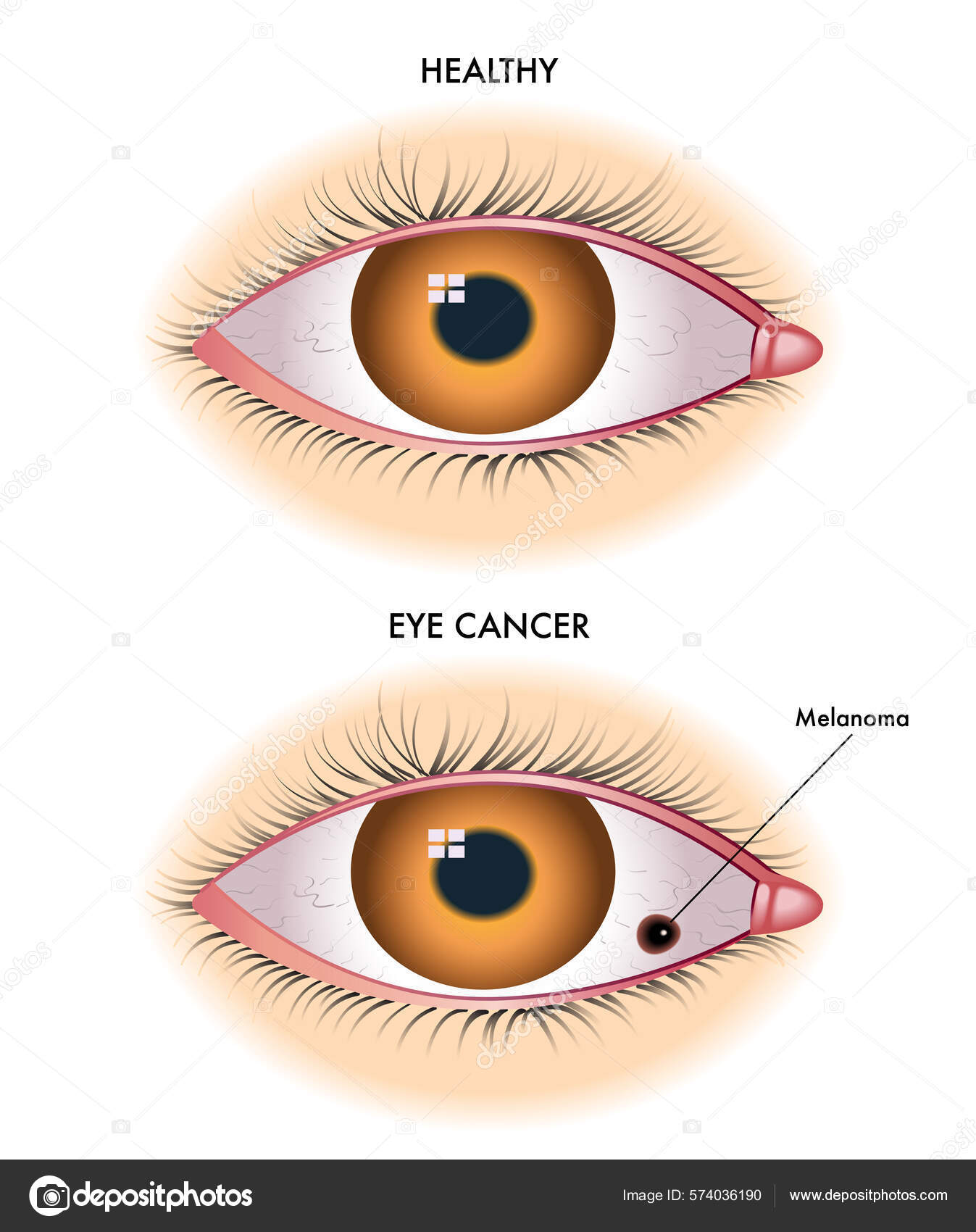 Vector Ilustración Cáncer Ojo Concepto Anatomía Vector de stock por ...