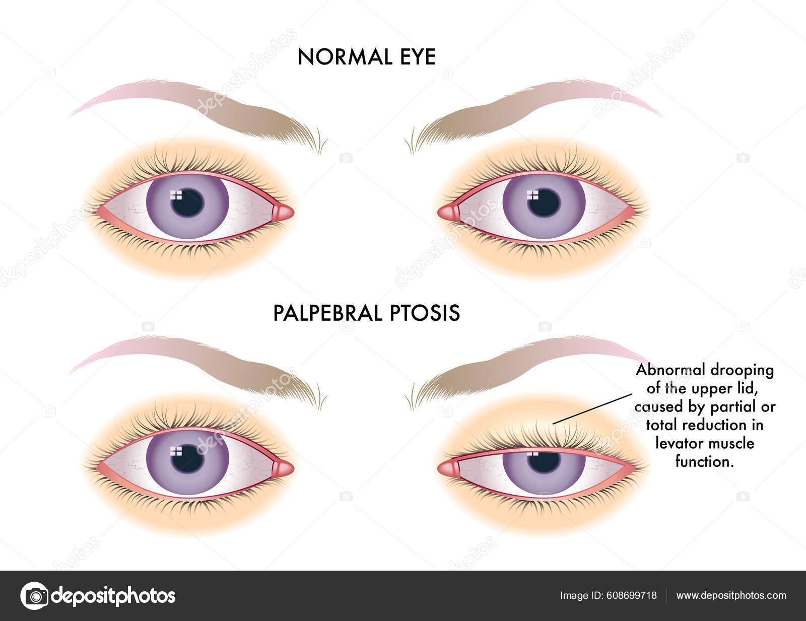 Ilustrasi Medis Menunjukkan Perbandingan Antara Mata Normal Dan Mata ...